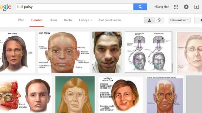 Mengenal penyakit Syndrom Bell's Palsy - setia1heri.com